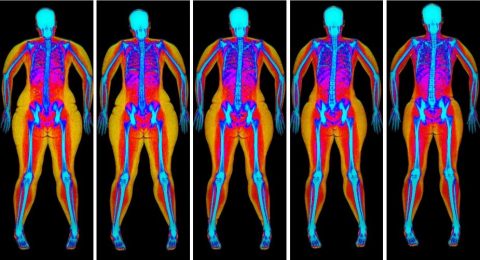 DEXA BODY COMPOSITION ANALYSIS - BGSA Radiology