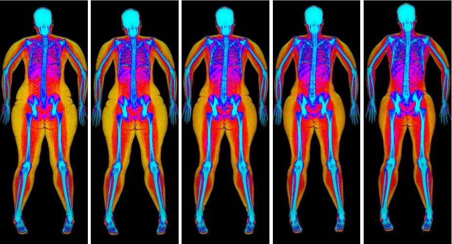 DEXA BODY COMPOSITION ANALYSIS BGSA Radiology DEXA BODY COMPOSITION ANALYSIS BGSA Radiology